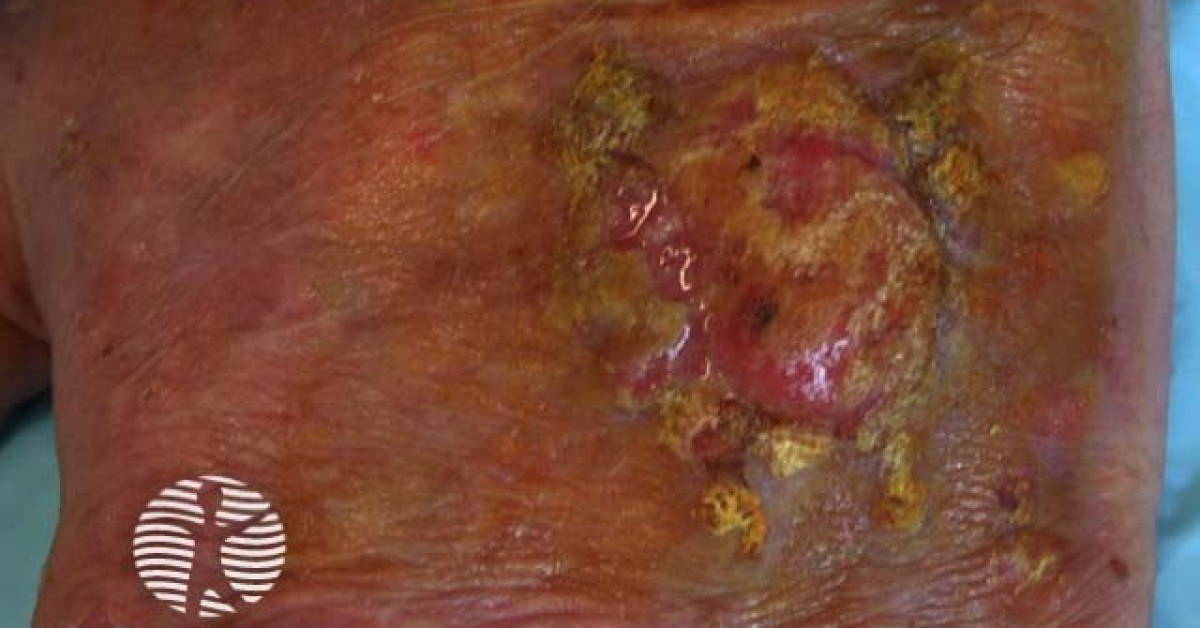 Intraepidermal carcinoma image