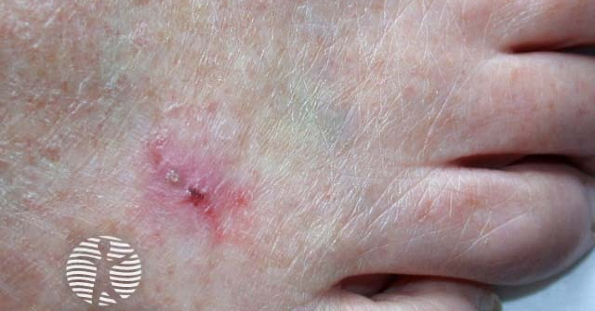 Intraepidermal carcinoma image