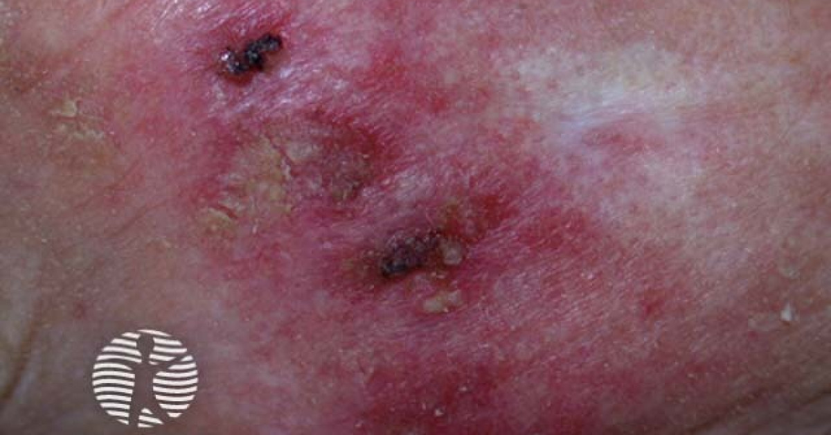 Intraepidermal carcinoma image