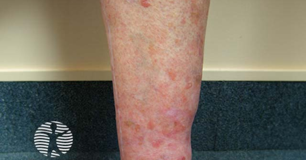 Intraepidermal carcinoma image