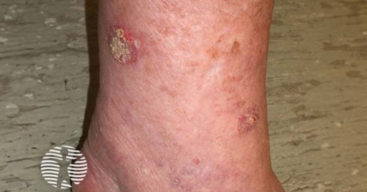 Intraepidermal carcinoma image
