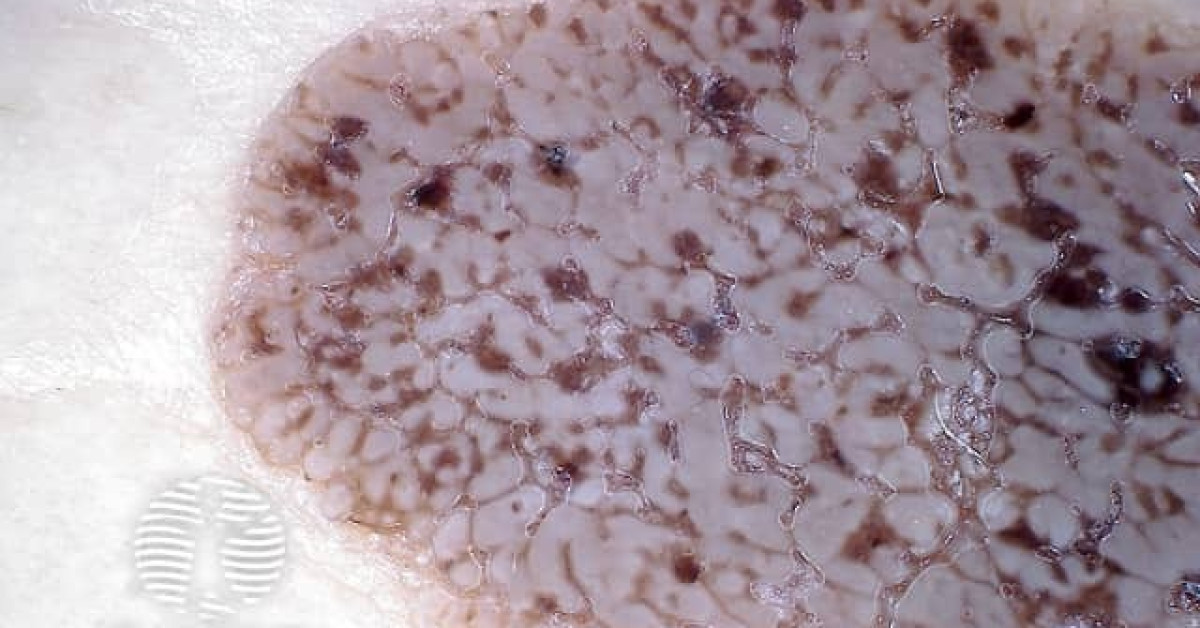 Seborrhoeic keratosis cerebriform pattern on dermatoscopy image