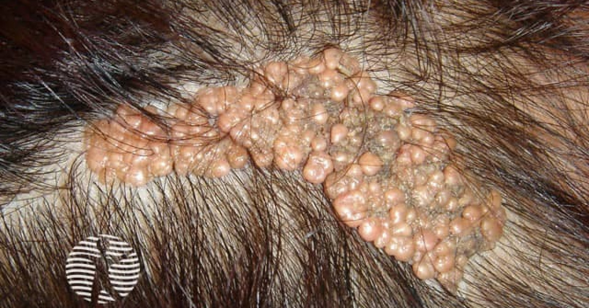 Sebaceous naevus image