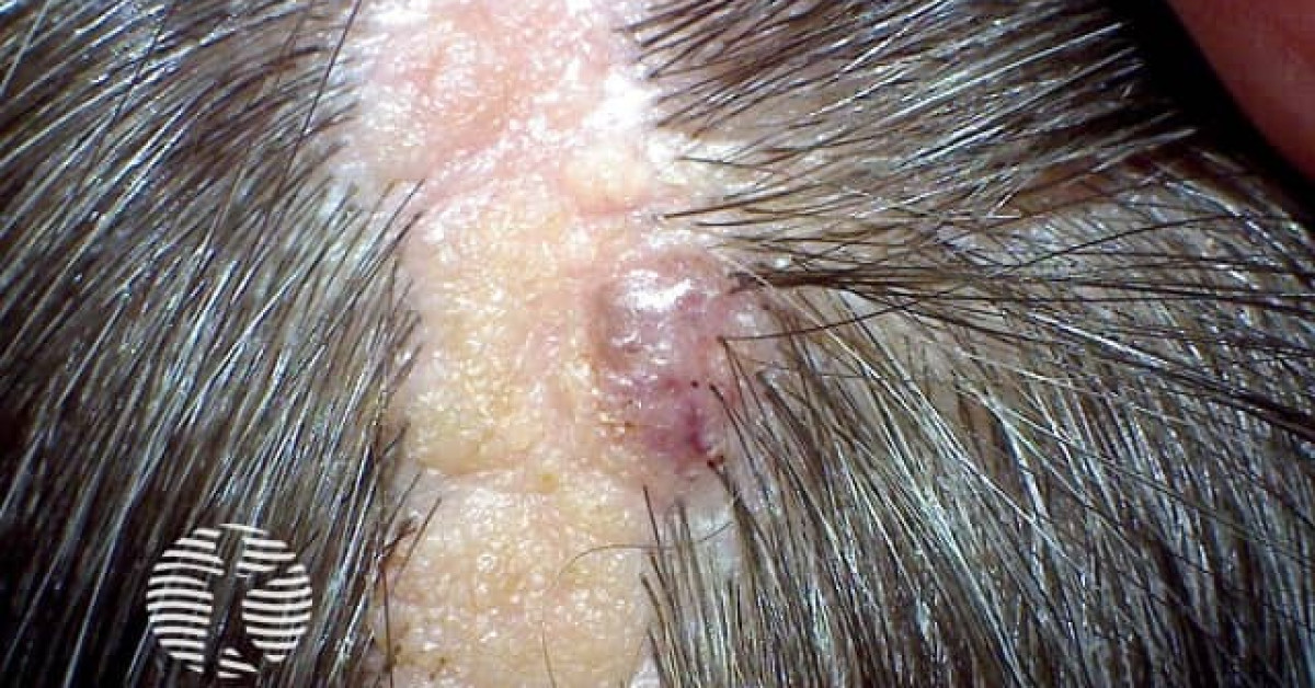 Sebaceous naevus with basal cell carcinoma image