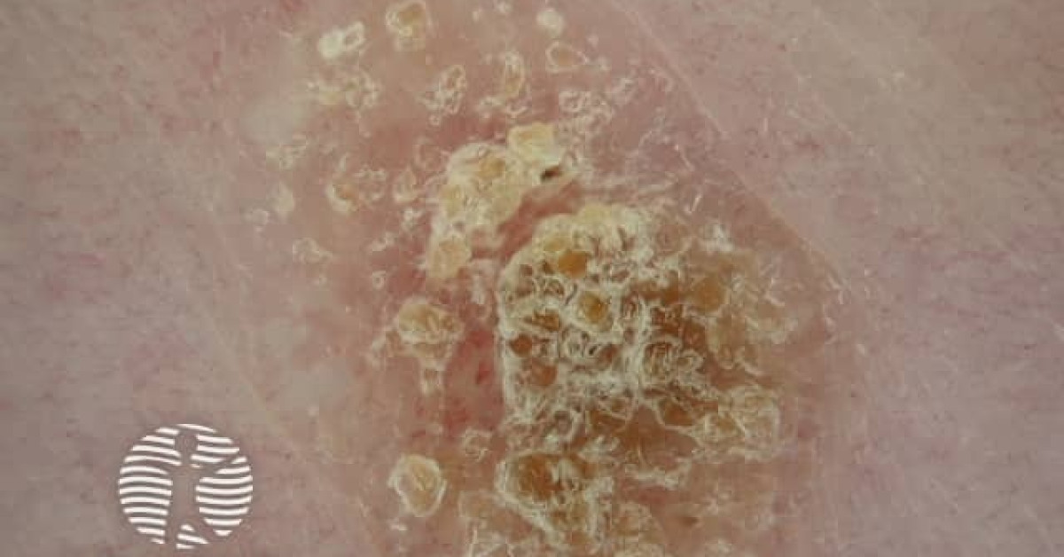 Seborrhoeic keratosis: dermoscopy image