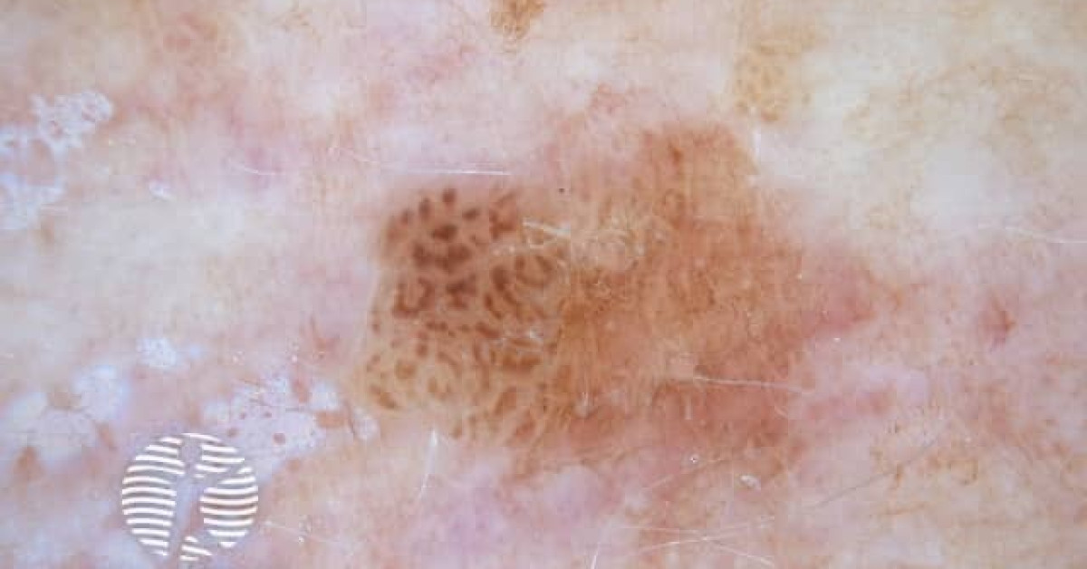 Seborrhoeic keratosis: dermoscopy image