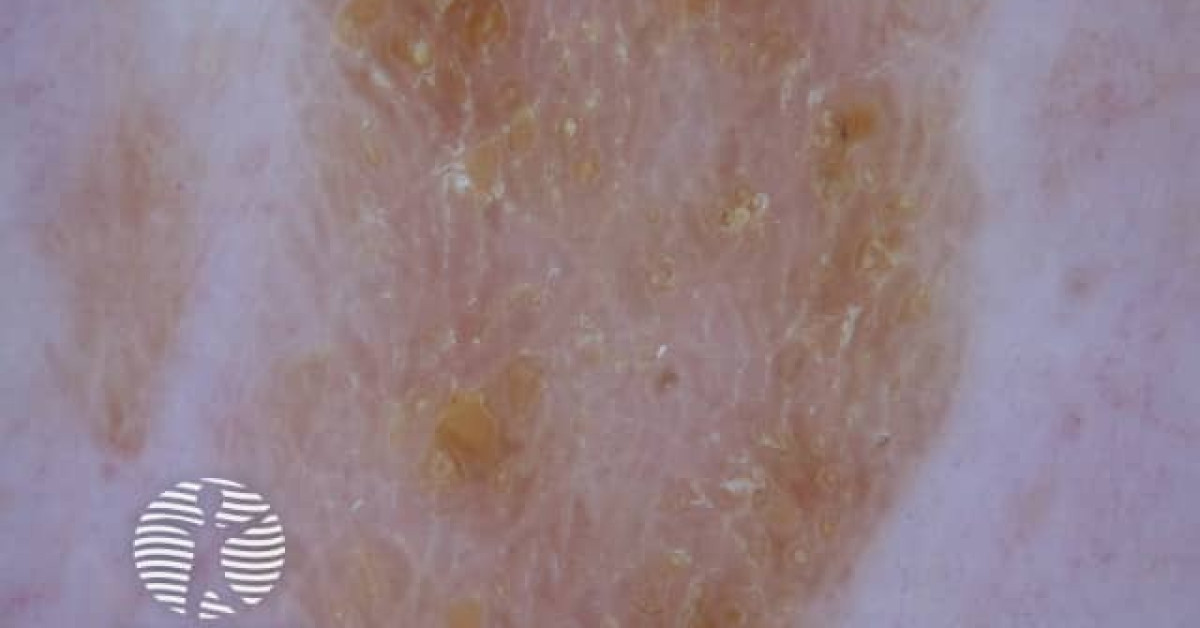 Seborrhoeic keratosis: dermoscopy image