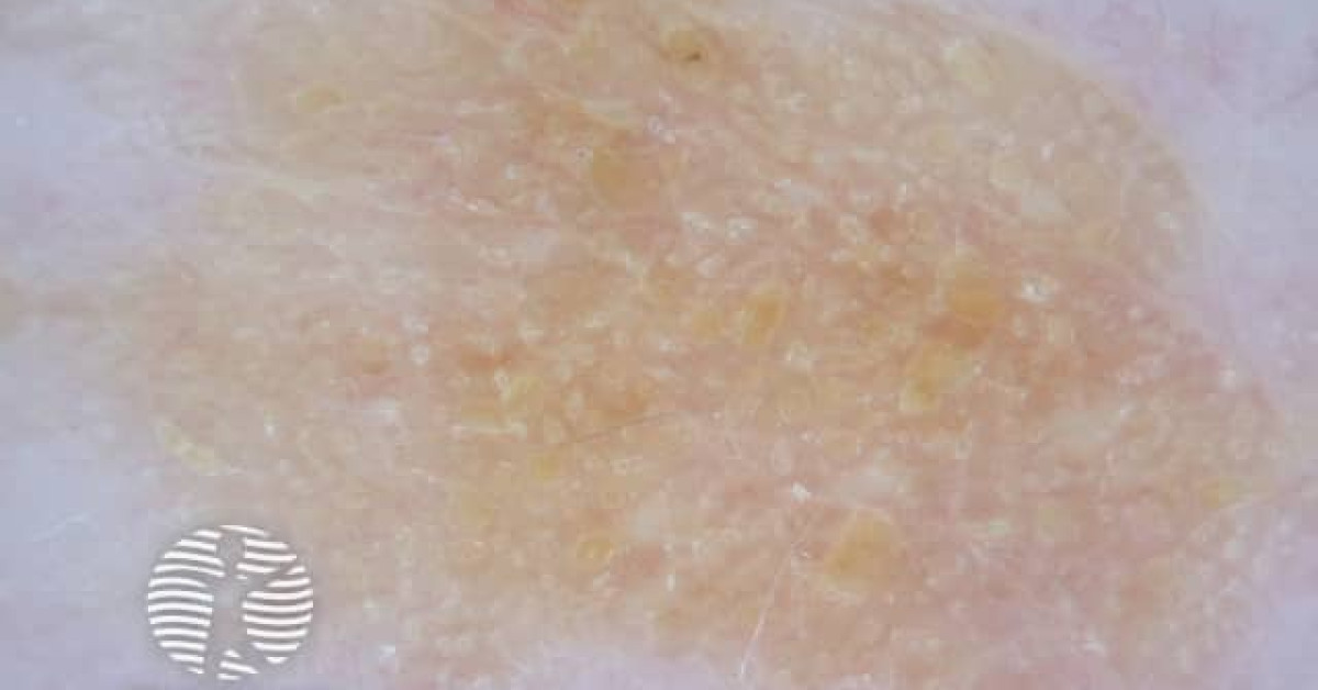Seborrhoeic keratosis: dermoscopy image