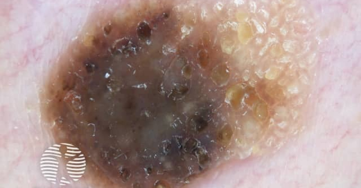 Seborrhoeic keratosis: dermoscopy image
