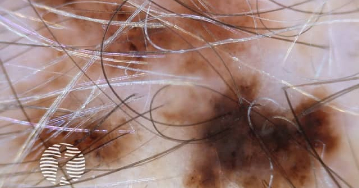 Seborrhoeic keratosis: dermoscopy image