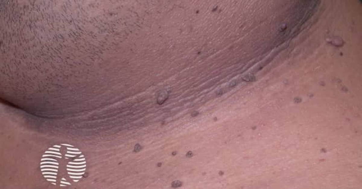 Skin tag image
