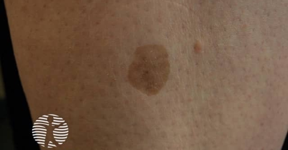 Solar lentigo image