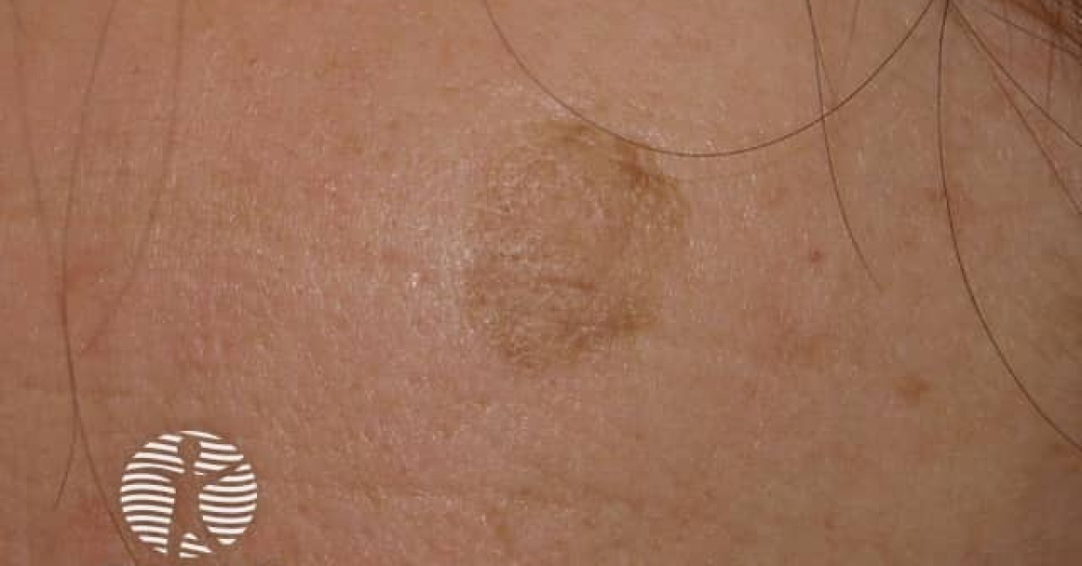 DermNet® - Solar lentigo image