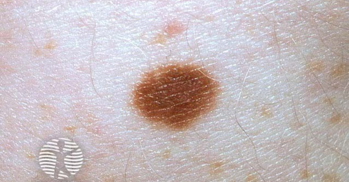 Solid brown naevus image