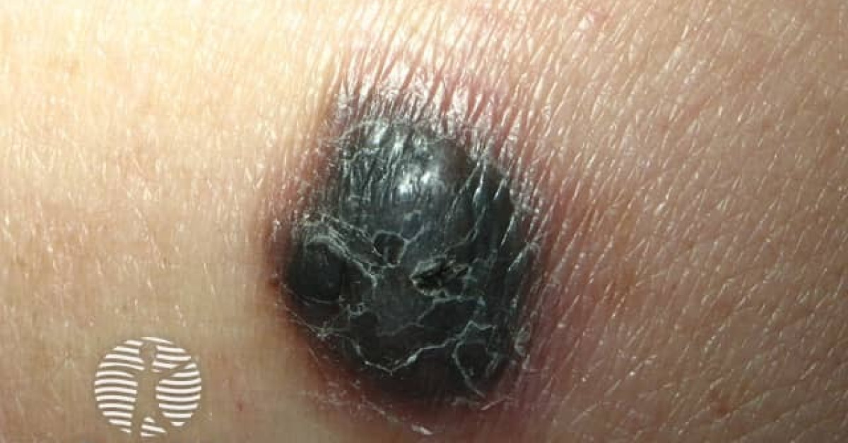 Spitzoid melanoma on the arm of an adult image