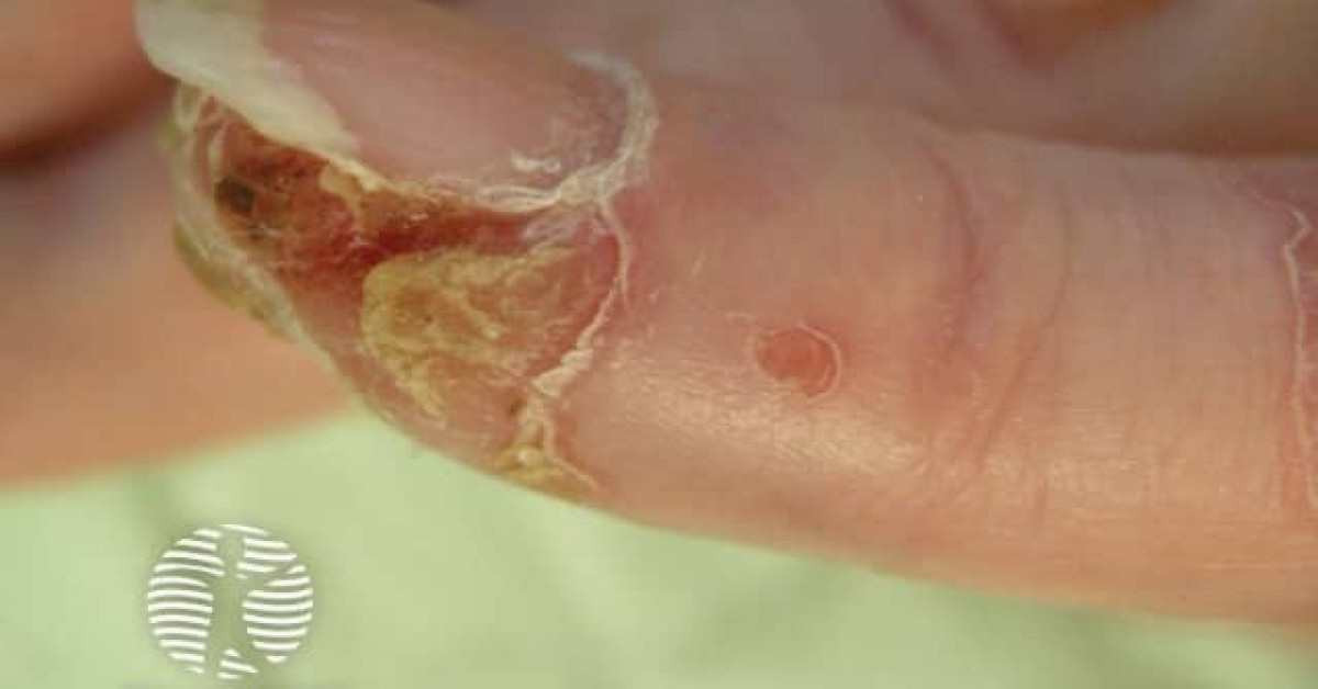 Ungual squamous cell carcinoma in situ image