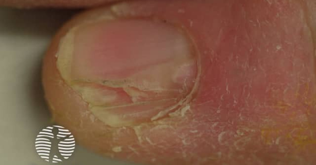 Ungual squamous cell carcinoma in situ image