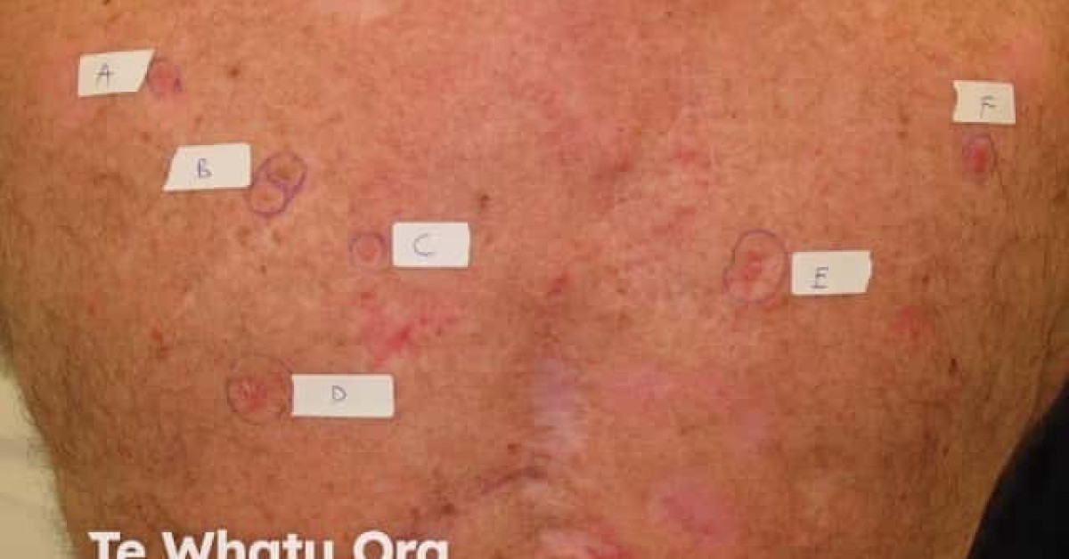 Superficial basal cell carcinoma, back image