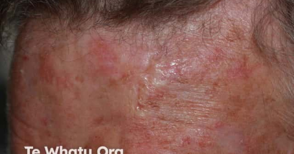 Morphoeic basal cell carcinoma image