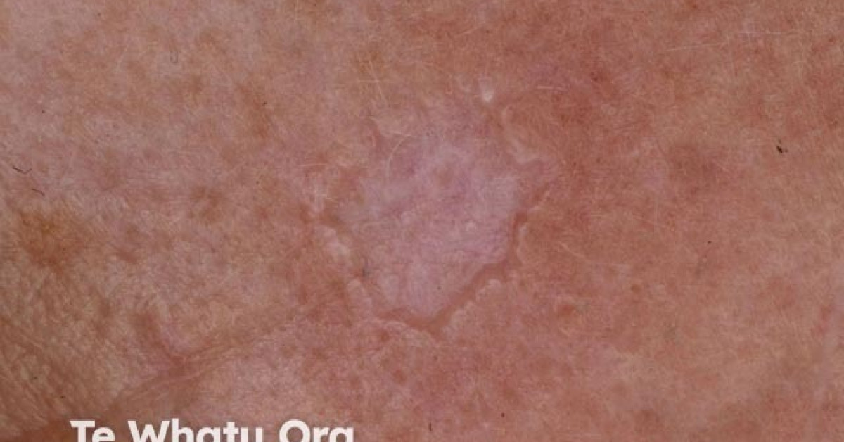 Ferguson-Smith disease SCC/KA image