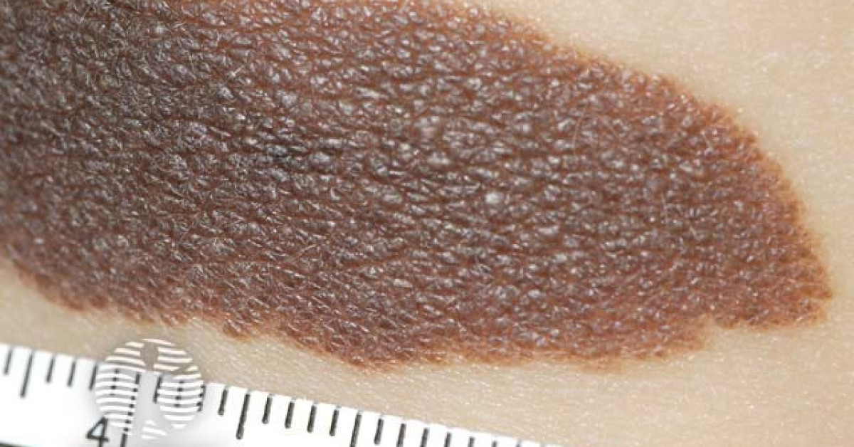 Pigmented congenital melanocytic naevus image