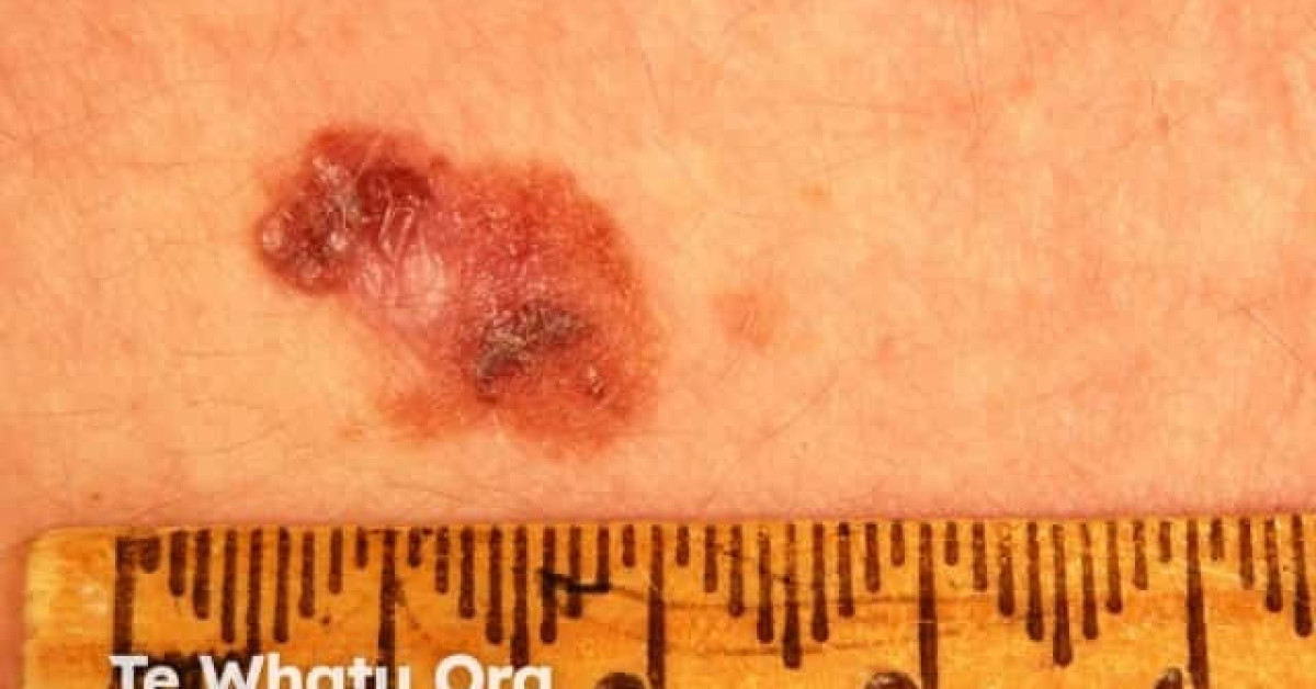 Superficial spreading melanoma image