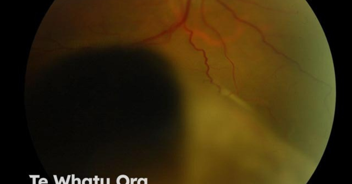 DermNet® - Uveal/choroidal melanoma image