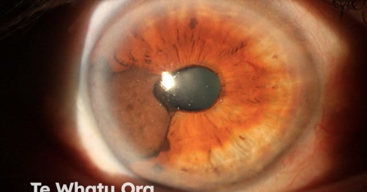 Uveal/iris melanoma image