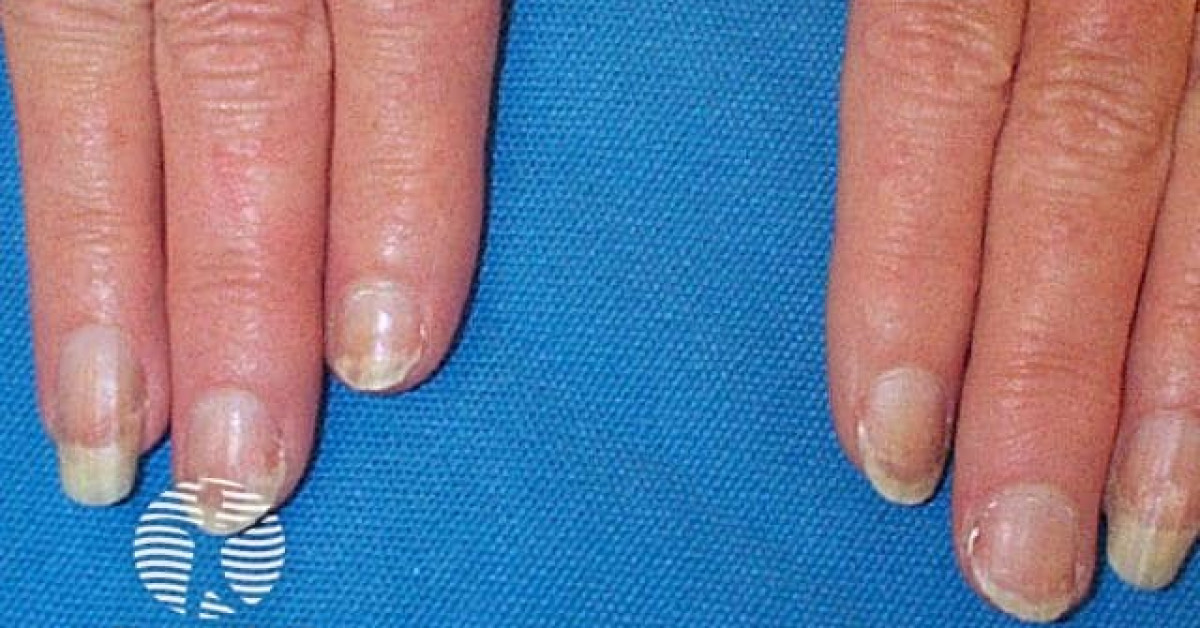 Nail dystrophy due to lichen planus image