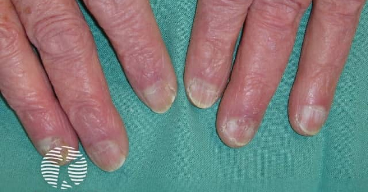 Nail dystrophy due to lichen planus image