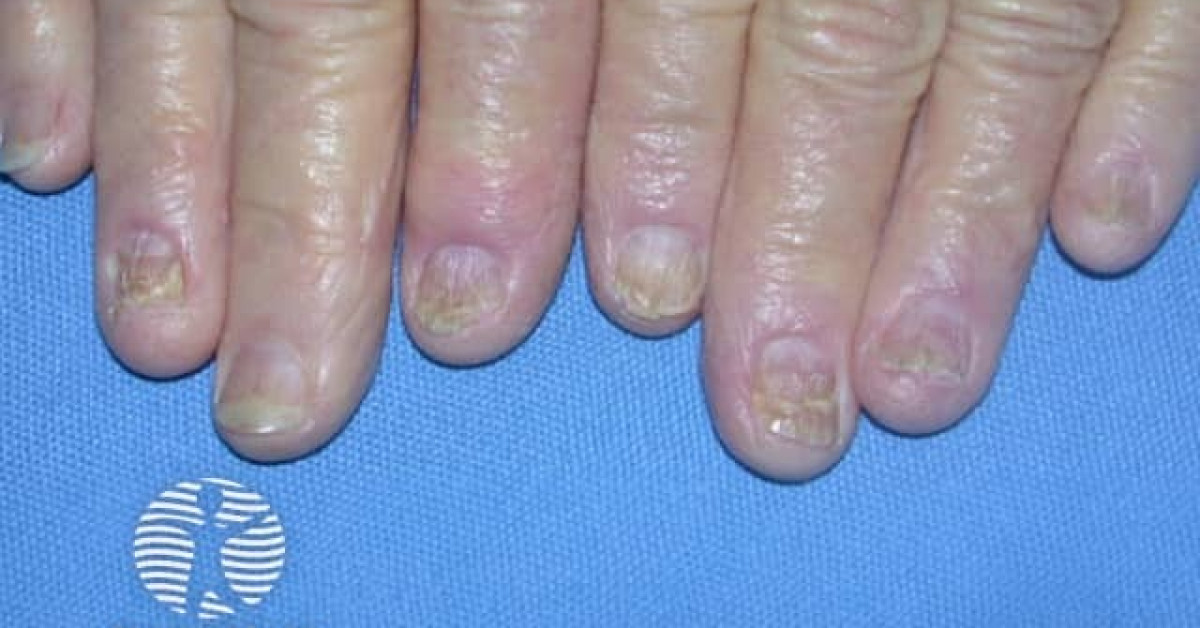 Nail dystrophy due to lichen planus image
