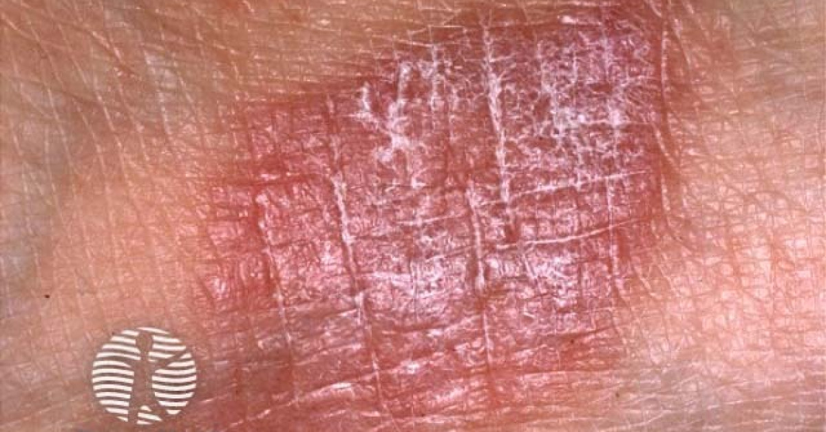 Lichen simplex image