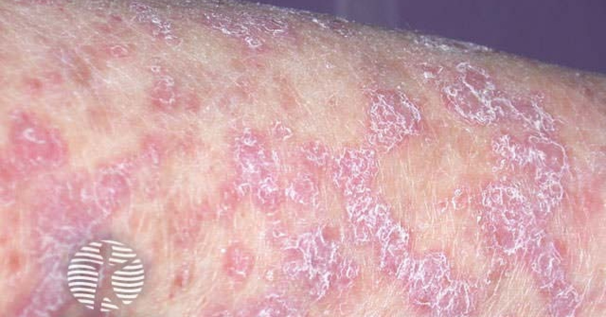 Lichen planus image