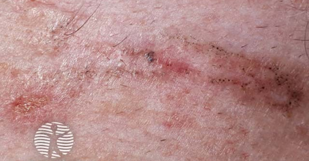 Linear pigmented basal cell carcinoma image
