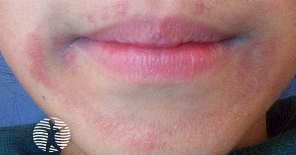 Lip Licker S Dermatitis Image