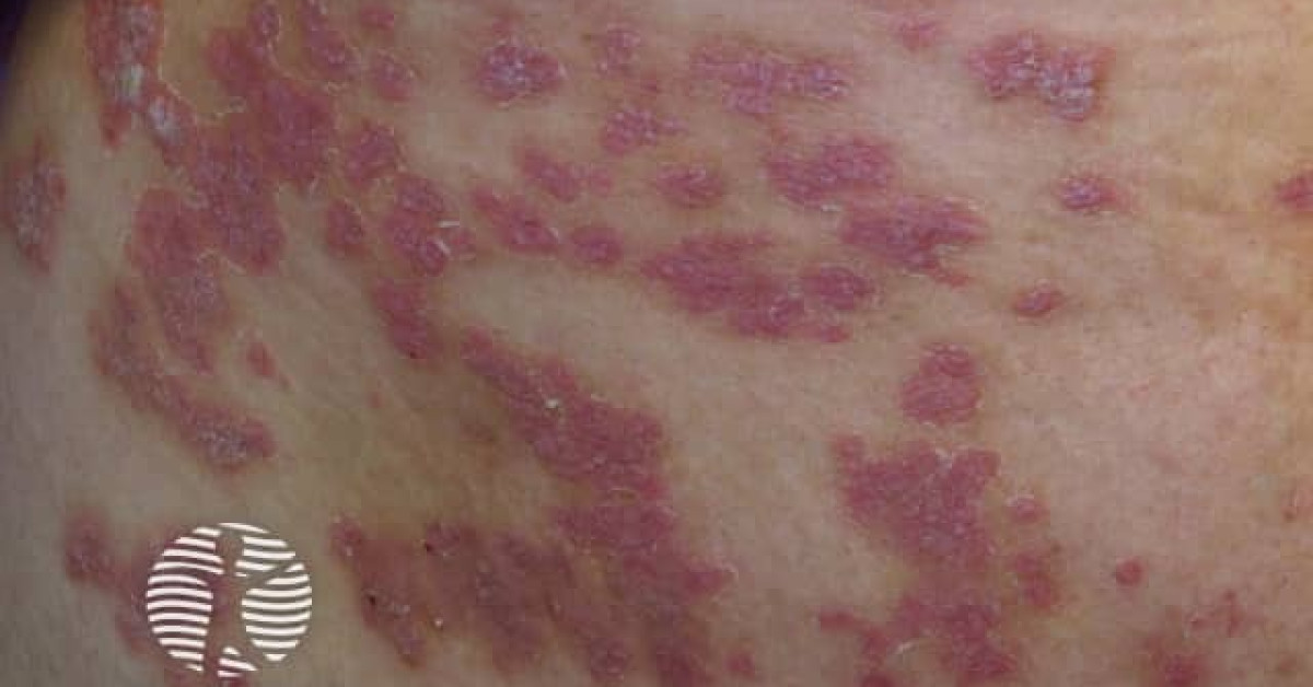 Psoriasis induced by lithium image