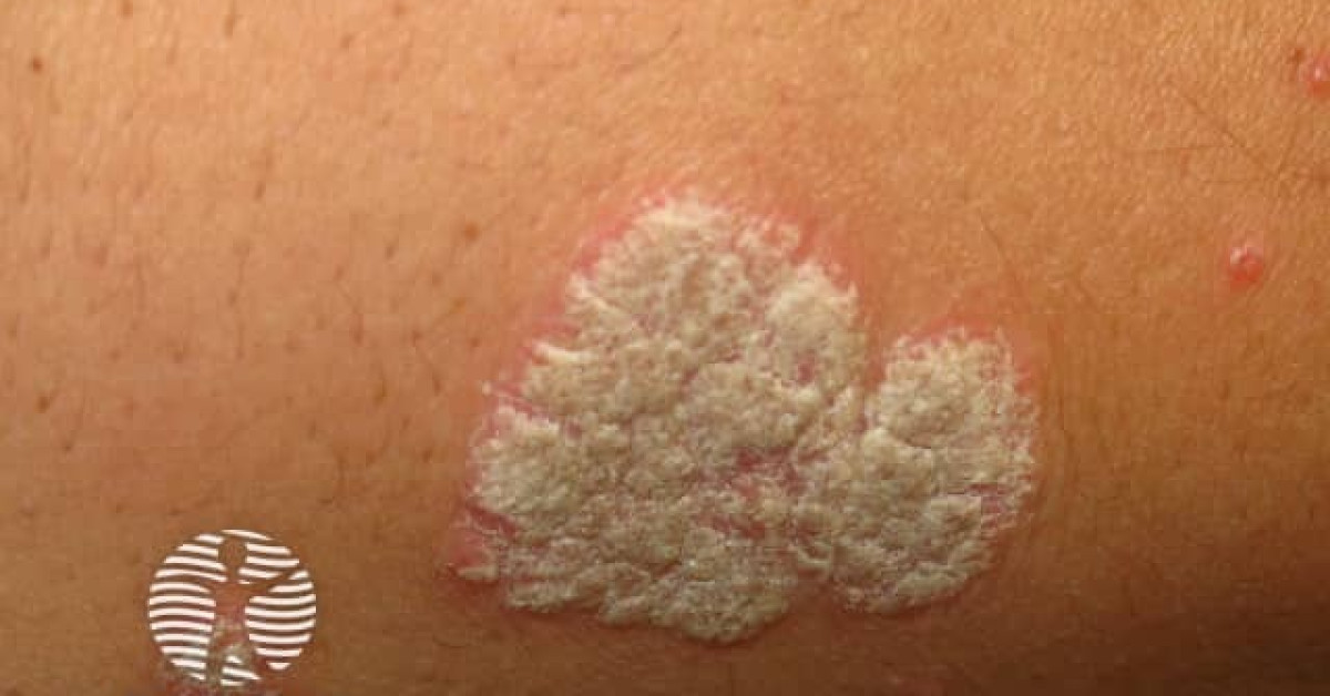 Psoriasis induced by lithium image