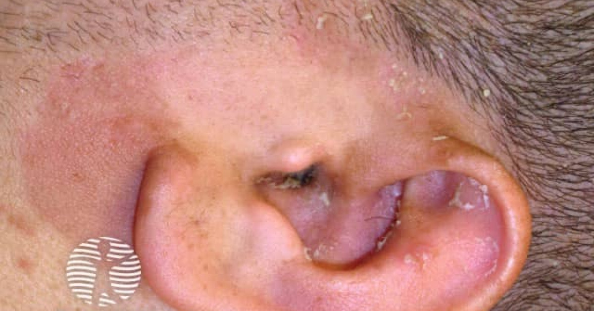 Psoriasis induced by lithium image