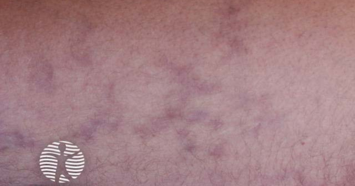 Livedo racemosa image