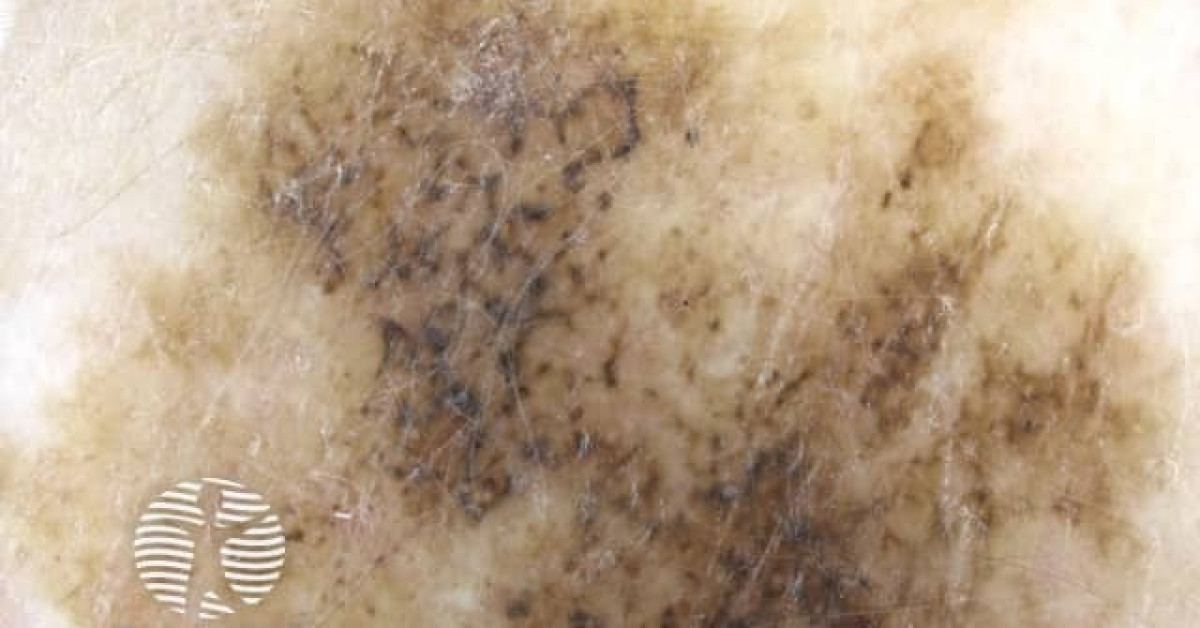 Annular granular pattern and rhomboids seen in dermoscopy of lentigo ...