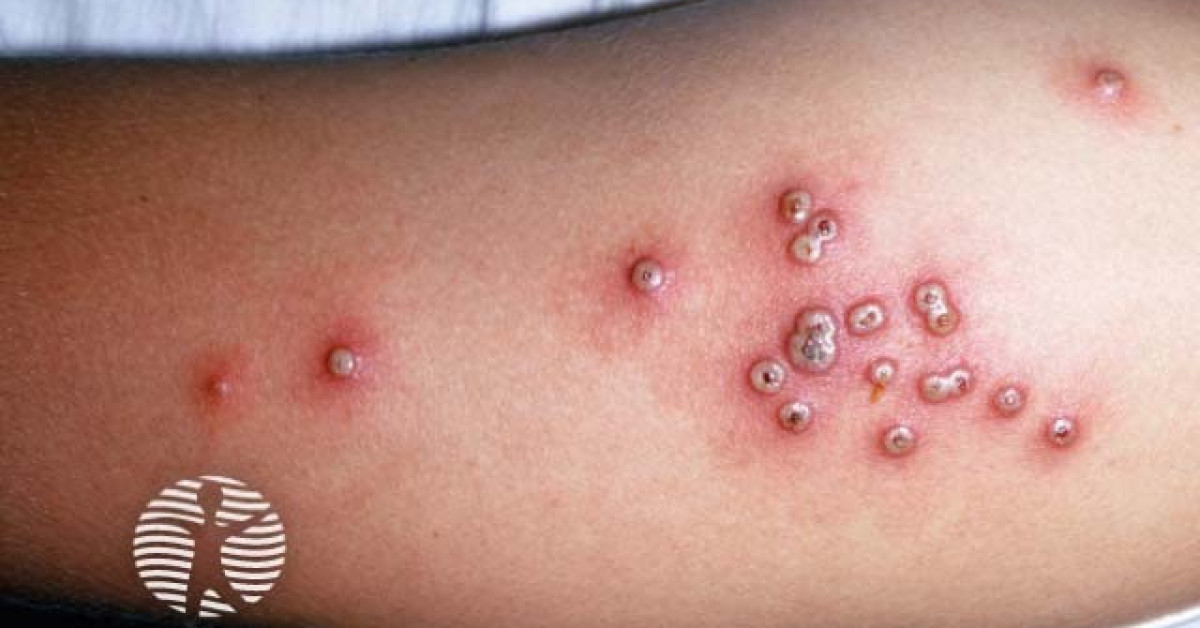 Vaccinia image