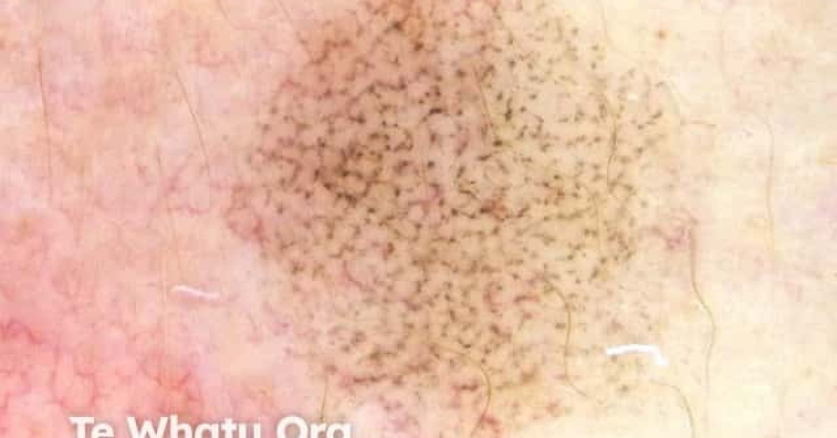 Annular granular pattern seen in dermoscopy of lichen planus-like ...