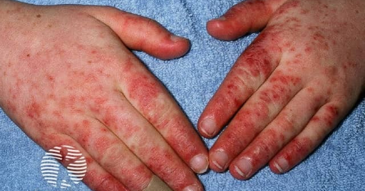 Systemic lupus erythematosus image