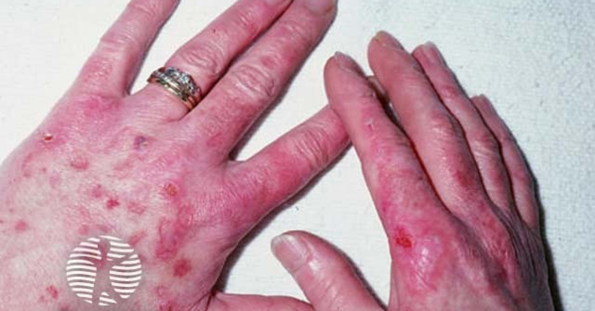 Discoid lupus erythematosus affecting dorsal hands image
