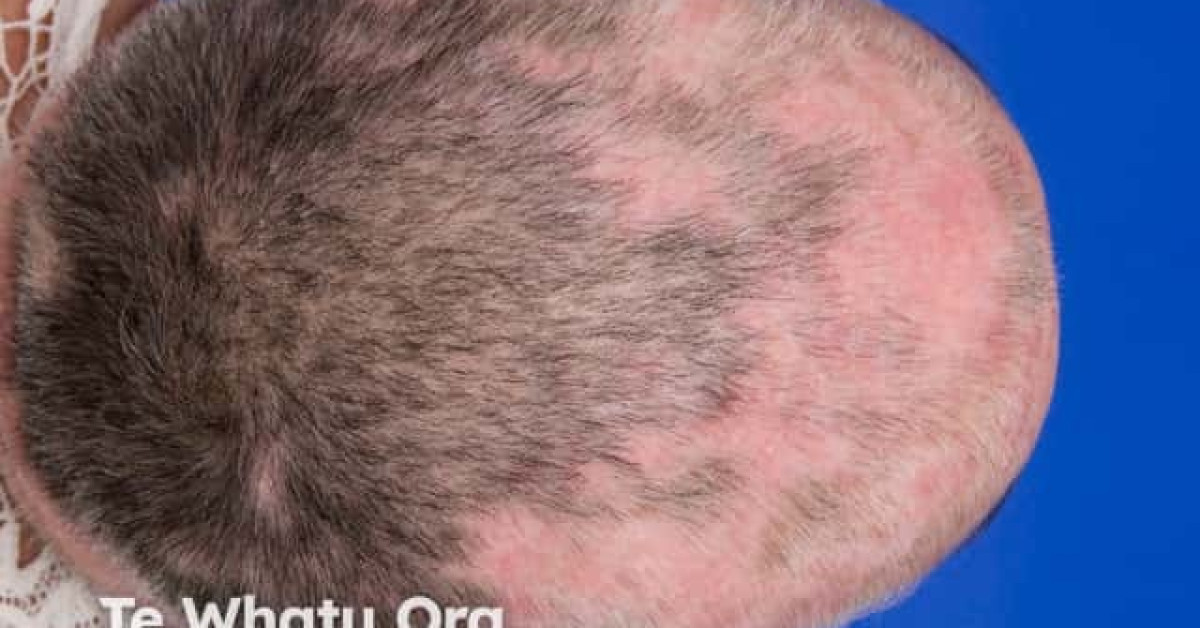 Scalp involvement in systemic lupus erythematosus image