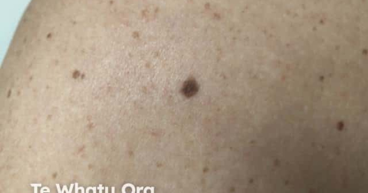 Melanocytic naevus image