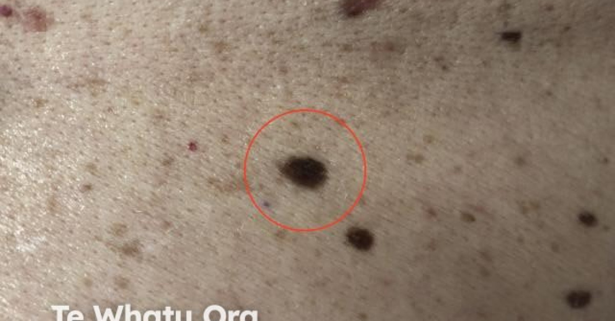 Melanocytic naevus image