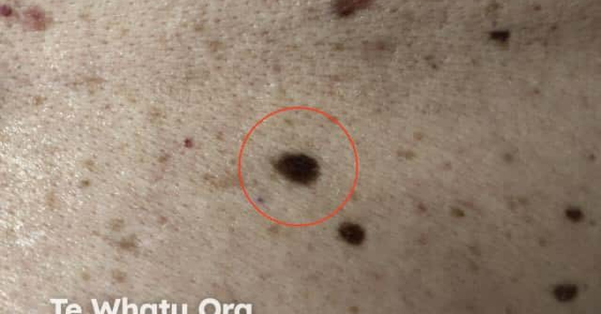 Melanocytic naevus image