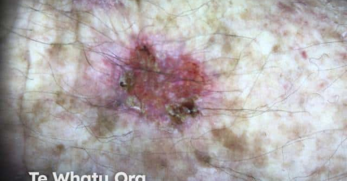 Squamous cell carcinoma in situ image