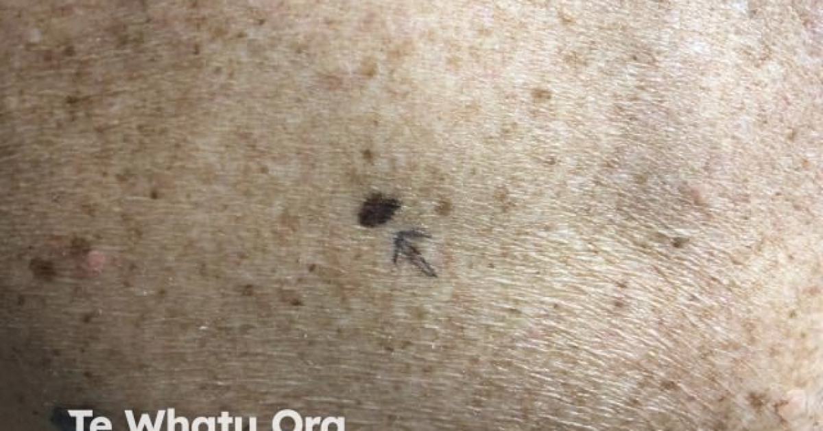 Superficial spreading melanoma image